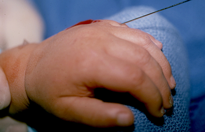 Metacarpal Synostosis Hand Surgery Resource